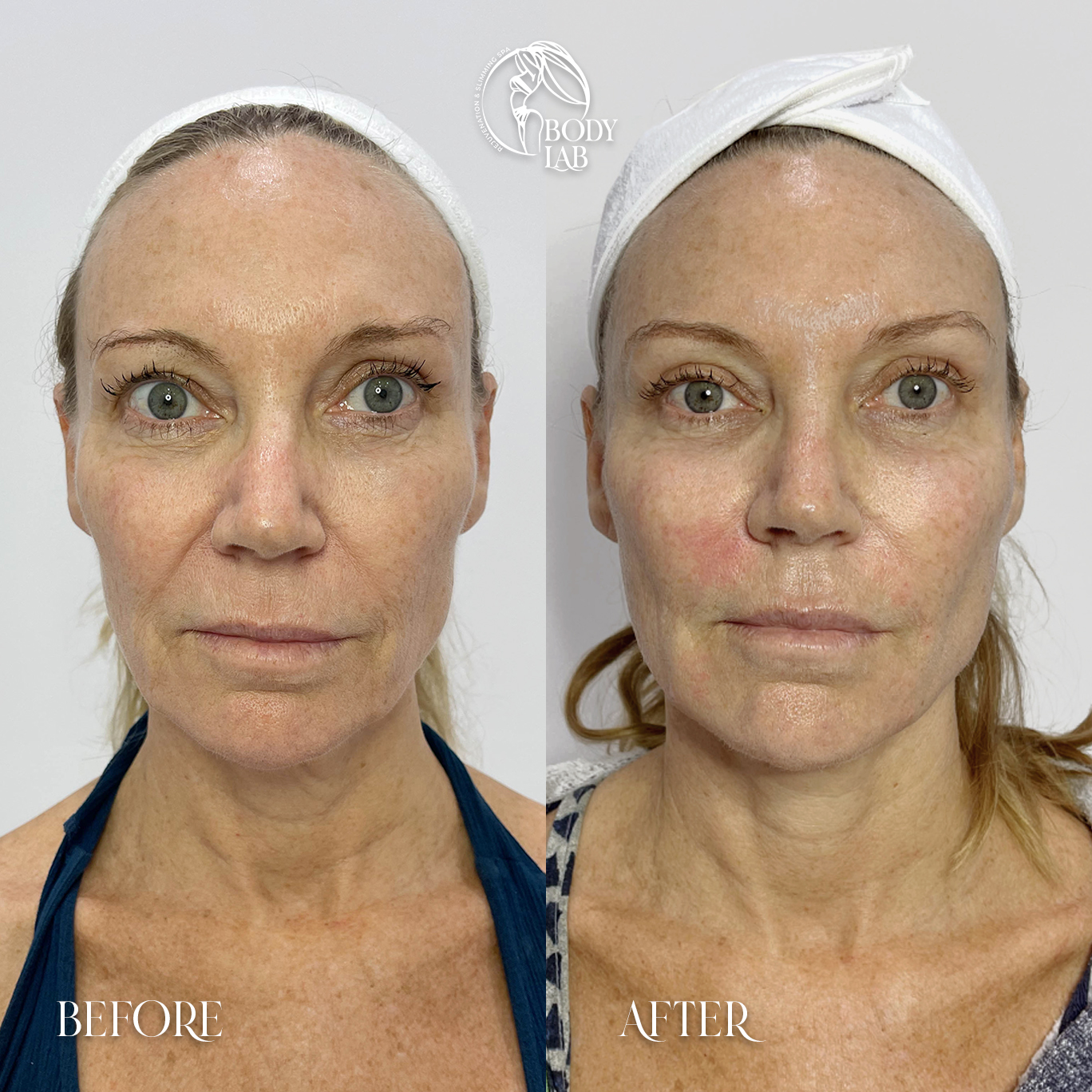 Before After – Body Lab Bali