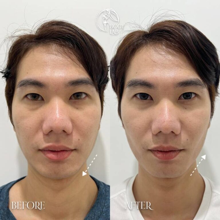 Liftera HIFU – Body Lab Bali